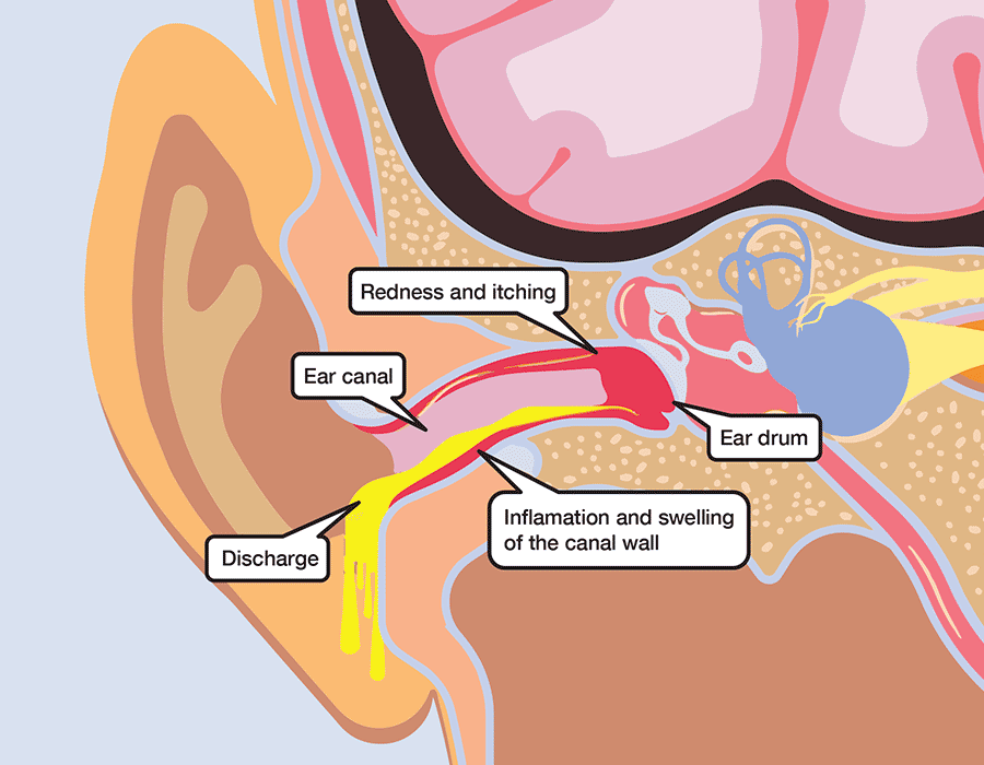 Effective Prevention and Treatment for Swimmer's Ear during Water ...